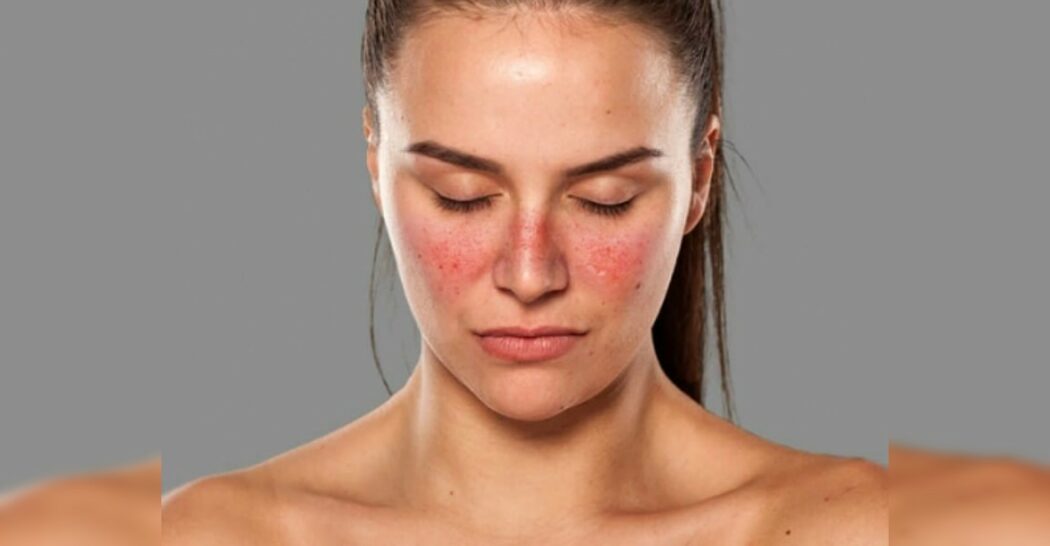 ¡ENFERMEDAD AUTOINMUNITARIA! Estas son las causas del lupus - Noticia ...