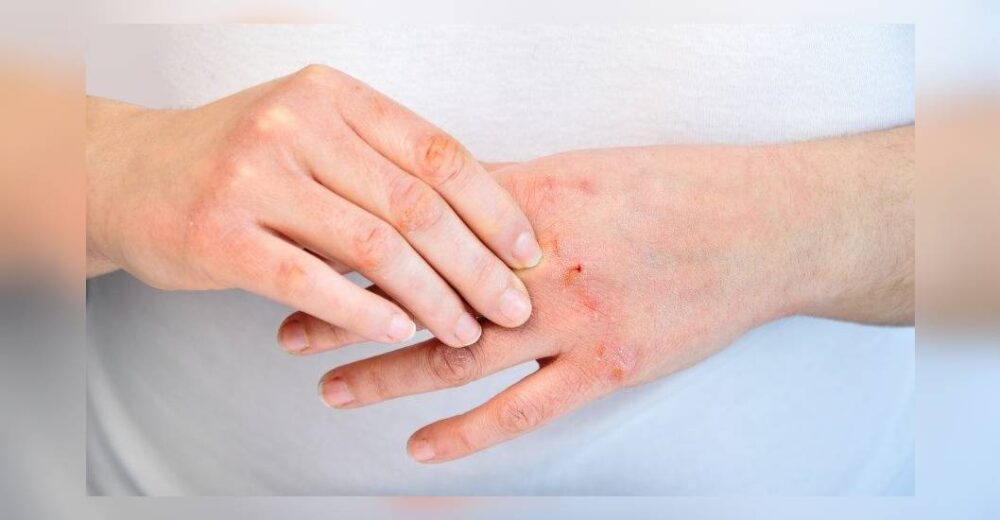 ¡PIERDEN HUMEDAD! Cuidados de las manos en el área de los nudillos ...